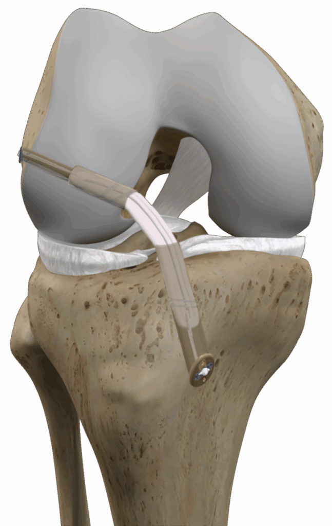 Anterior Cruciate Ligament Surgery | Dr. Samuel Duff