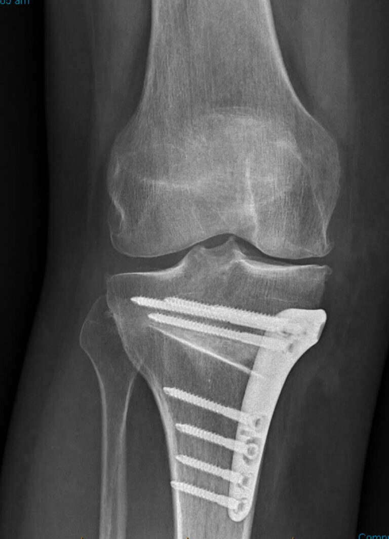 Osteotomy surgery in Perth | Dr. Samuel Duff