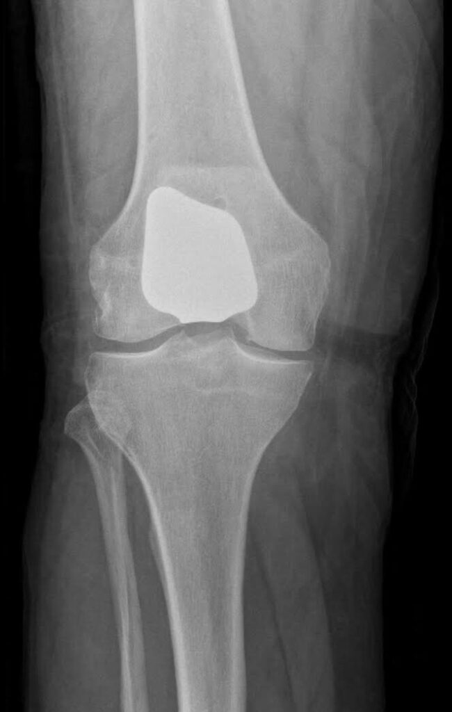 Patellofemoral (Kneecap) Replacement in Perth | Dr. Samuel Duff